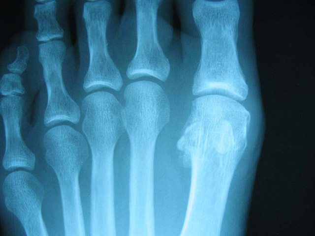 15 Gene Mutations That Could Make You Superhuman | Buzzworthy